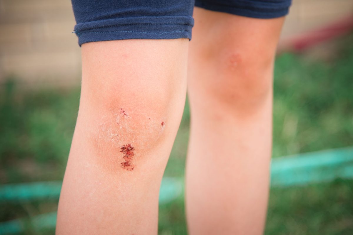 The Blessings of Skinned Knees